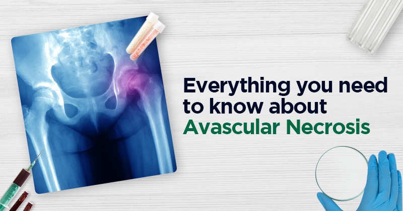 Everything you need to know about Avascular Necrosis